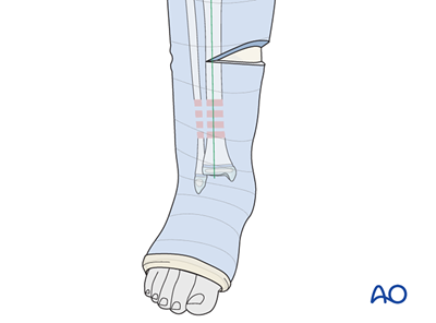 Closed reduction - Casting for Simple oblique or spiral tibial fracture