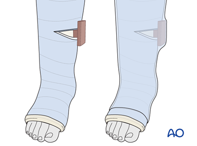 Nonoperative treatment - Long leg cast for Simple oblique or spiral ...