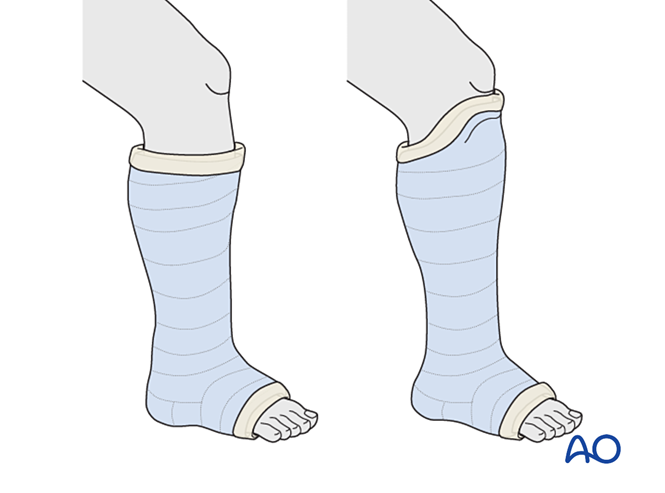 Nonoperative treatment - Long leg cast for Simple oblique or spiral ...