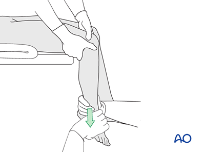 Closed reduction - Casting for Simple oblique or spiral tibial fracture