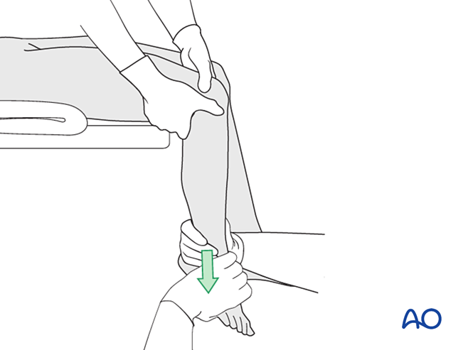 Closed reduction - Casting for Simple oblique or spiral tibial fracture