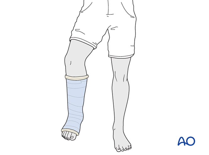 Below-knee cast