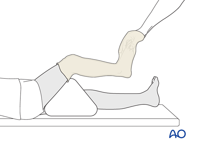 Nonoperative treatment - Below-knee cast for Isolated fibular fracture