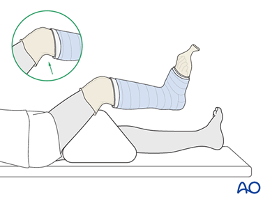 Nonoperative treatment - Below-knee cast for Isolated fibular fracture