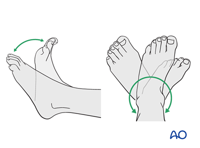 Closed reduction - Casting for Simple oblique or spiral tibial fracture