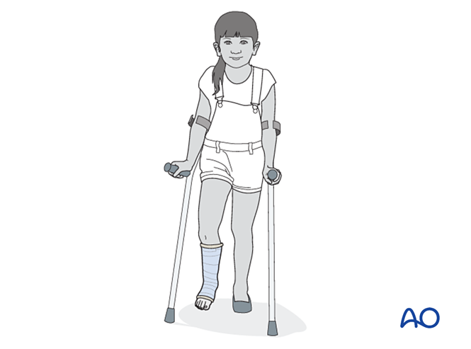 Nonoperative treatment - Below-knee cast for Isolated fibular fracture