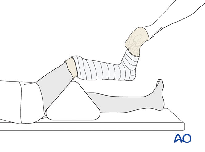 Patellar tendon bearing cast (Sarmiento)