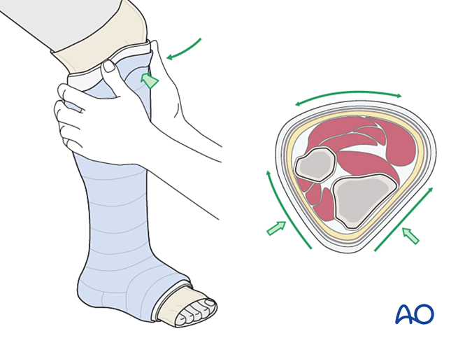 Patellar tendon bearing cast (Sarmiento)