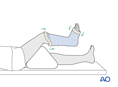 Patellar tendon bearing cast (Sarmiento)