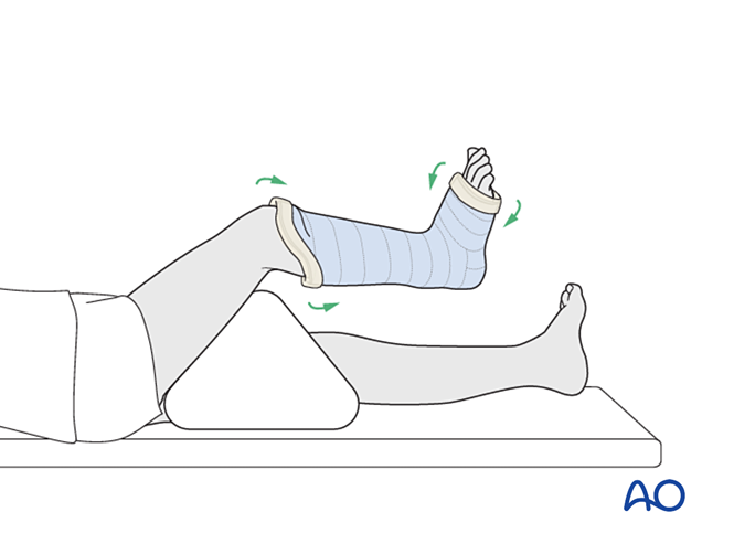 Patellar tendon bearing cast (Sarmiento)