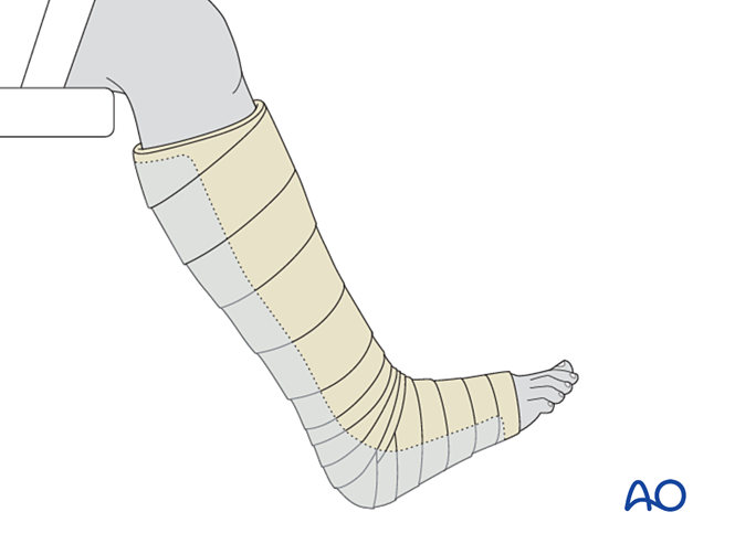 Nonoperative treatment - Splinting for Isolated fibular fracture