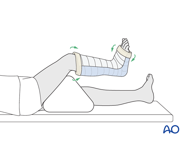 Nonoperative treatment - Splinting for Isolated fibular fracture