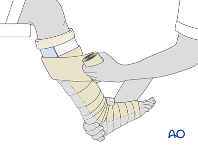 Nonoperative treatment - Splinting for Toddler’s fracture