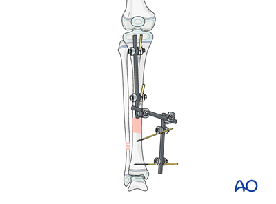 External fixation for Simple oblique or spiral tibial fracture
