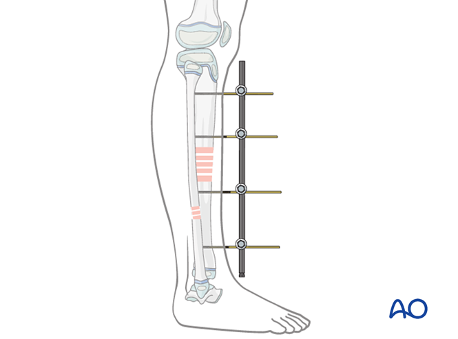External fixation for Simple oblique or spiral tibial fracture