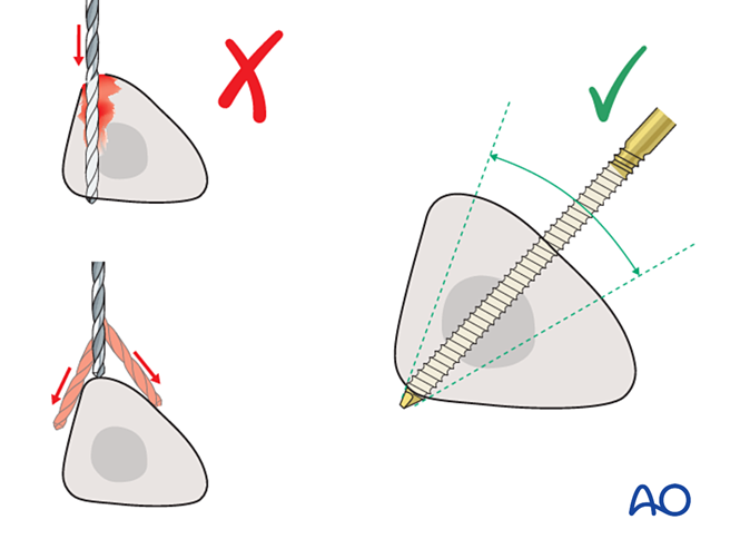External fixation for Simple oblique or spiral tibial fracture