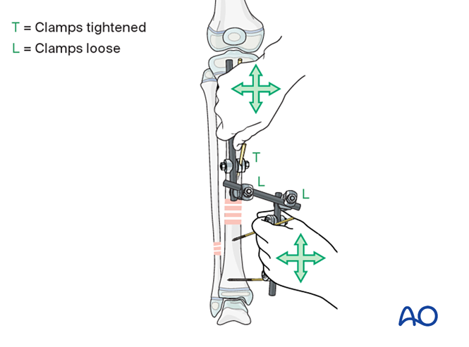 External fixation for Simple oblique or spiral tibial fracture
