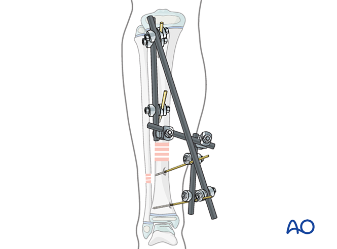 External fixation for Simple oblique or spiral tibial fracture