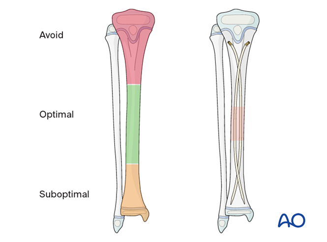 Elastic nailing for Simple transverse tibial fracture