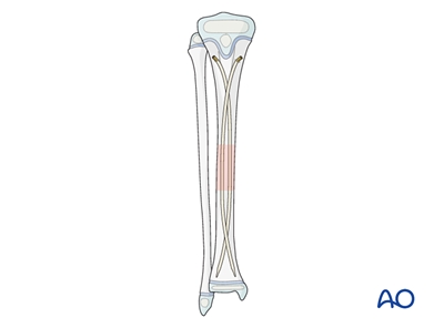 Elastic nailing for Simple transverse tibial fracture