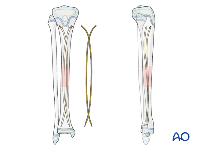 Elastic nailing for Simple transverse tibial fracture