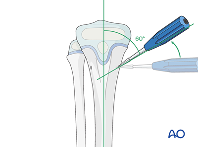 Elastic nailing for Simple transverse tibial fracture