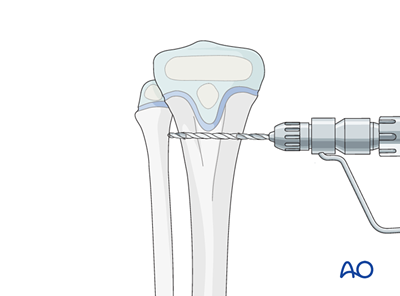 Elastic nailing for Simple transverse tibial fracture