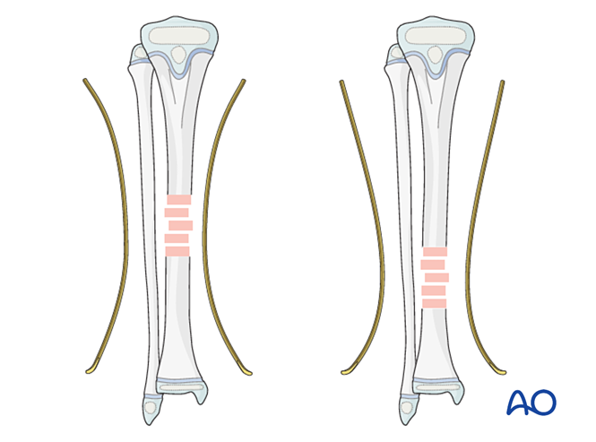 Elastic nailing for Simple transverse tibial fracture