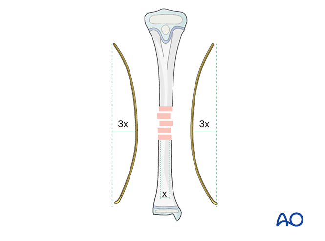 Elastic nailing for Simple transverse tibial fracture