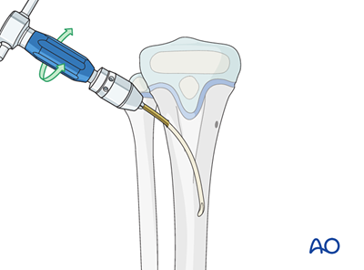 Elastic nailing for Simple oblique or spiral tibial fracture