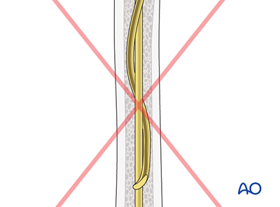 Elastic nailing for Multifragmentary tibial fracture