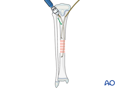 Elastic nailing for Simple transverse tibial fracture
