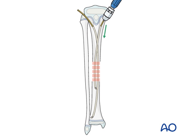 Elastic nailing for Simple transverse tibial fracture