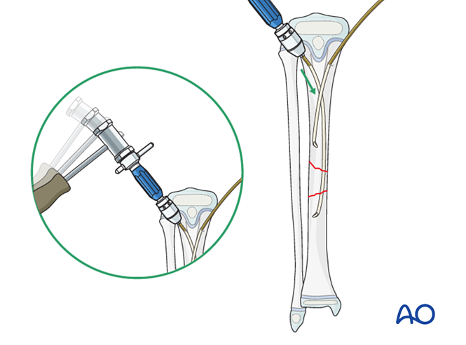Elastic nailing for Multifragmentary tibial fracture
