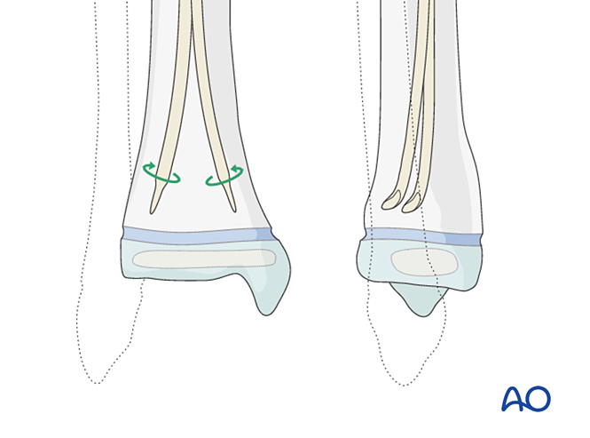 Elastic nailing for Simple transverse tibial fracture