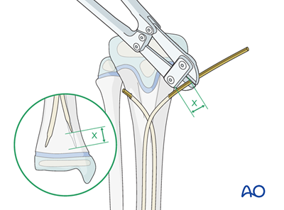 Elastic nailing for Simple transverse tibial fracture
