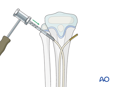 Elastic nailing for Simple transverse tibial fracture