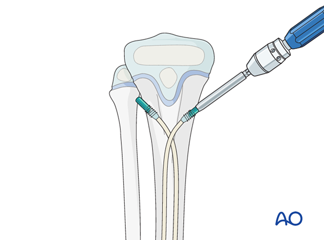 Elastic nailing for Simple oblique or spiral tibial fracture