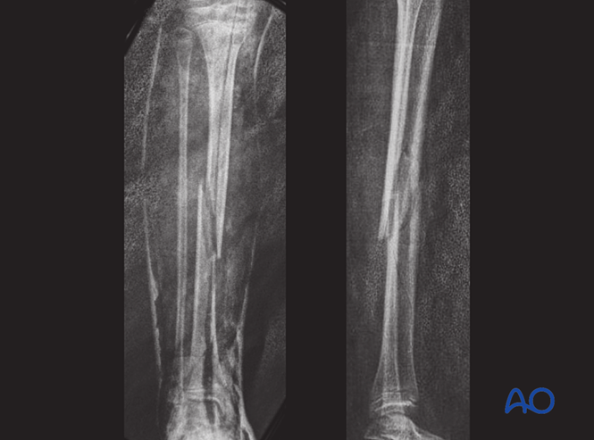 Elastic nailing for Simple oblique or spiral tibial fracture