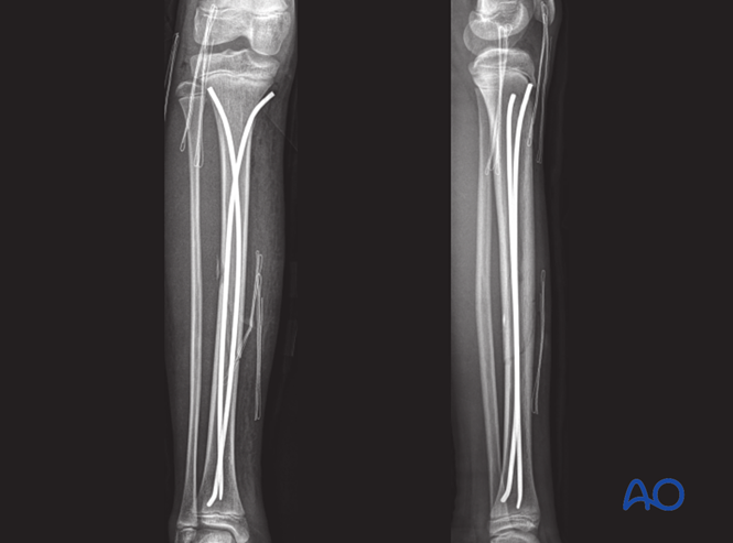 Elastic nailing for Simple oblique or spiral tibial fracture