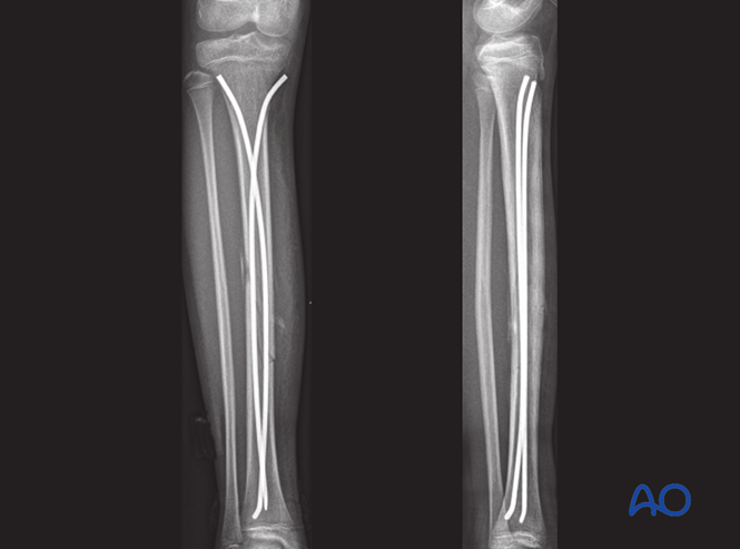 Elastic nailing for Simple oblique or spiral tibial fracture