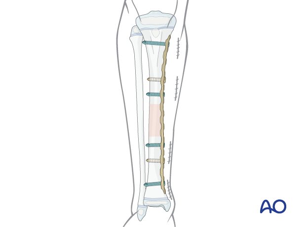 Mipo For Multifragmentary Tibial Fracture