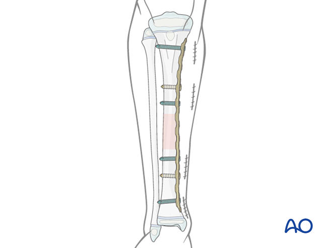 MIPO for Multifragmentary tibial fracture
