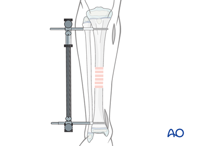MIPO for Multifragmentary tibial fracture