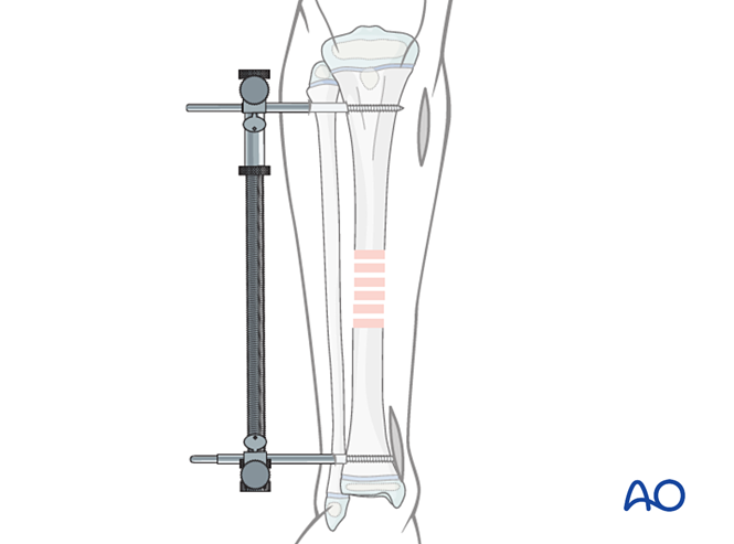 MIPO for Multifragmentary tibial fracture