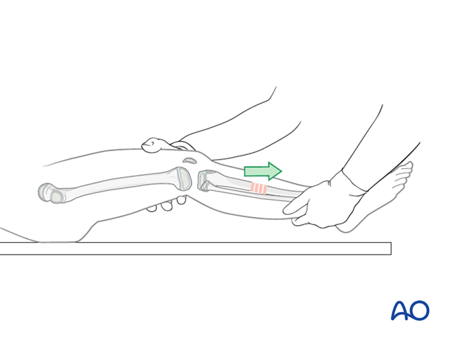 MIPO for Multifragmentary tibial fracture