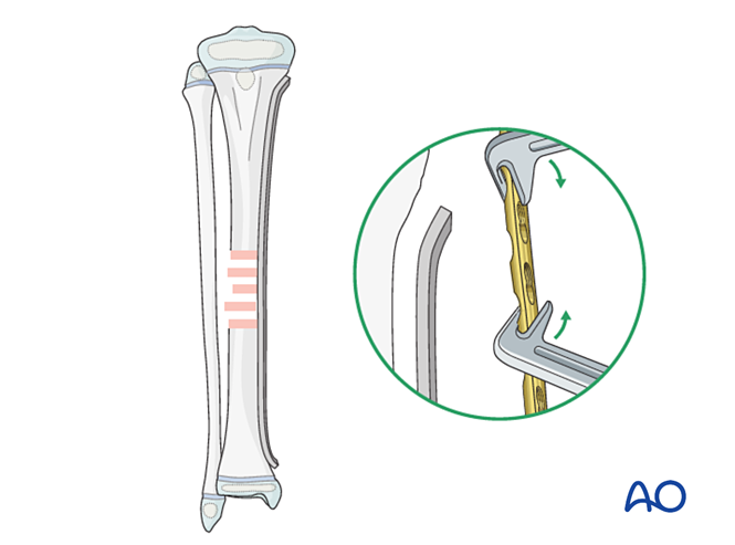 MIPO for Multifragmentary tibial fracture