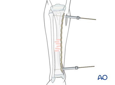 MIPO for Multifragmentary tibial fracture