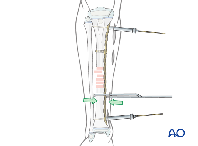 MIPO for Multifragmentary tibial fracture