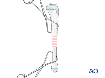 Open reduction - Plate fixation for Simple transverse tibial fracture